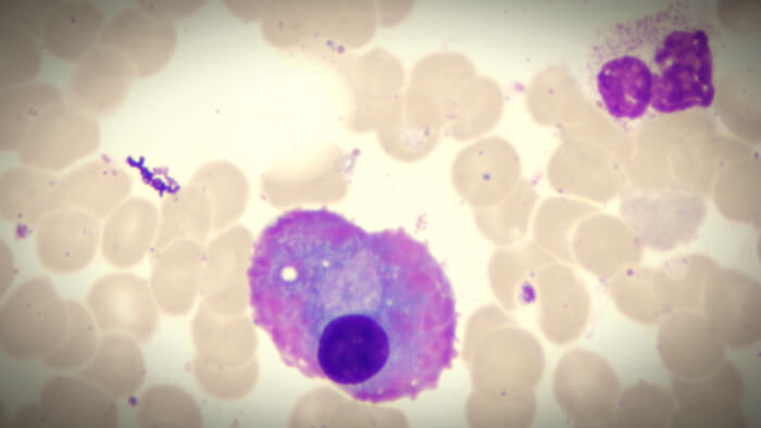 A New Option for High-Risk Multiple Myeloma? - Giving Compass