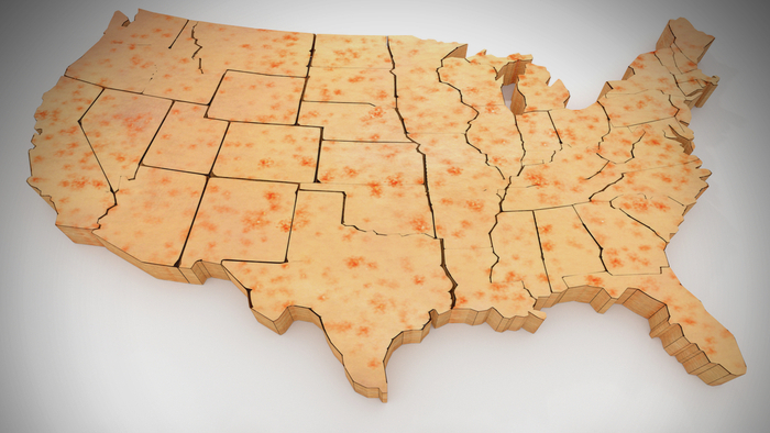 Map Shows Top U.S. Counties that Will Experience Measles Outbreak ...